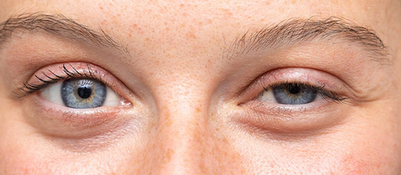 Pálpebras - Marcelo Golbert